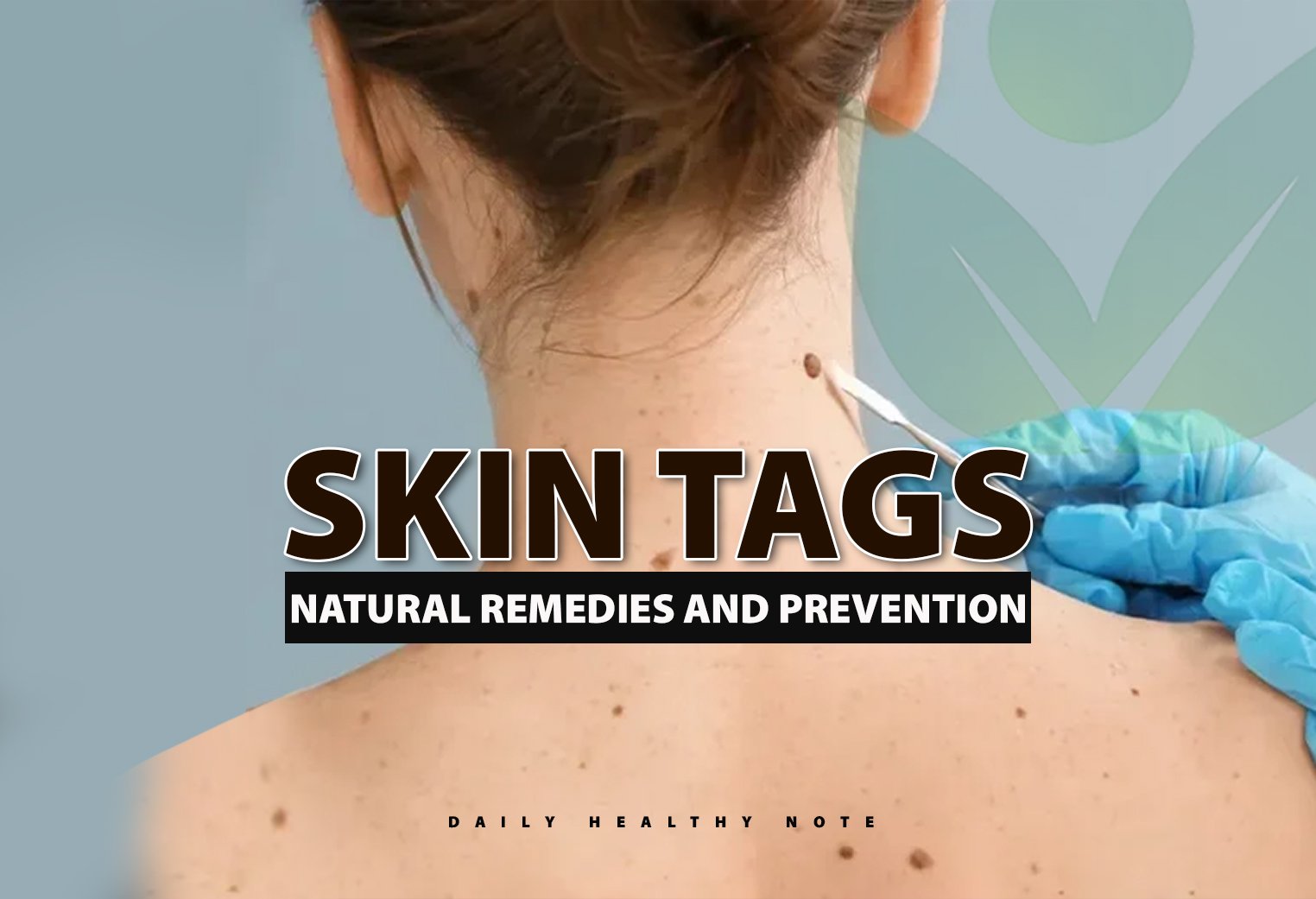 "Natural Remedies and Prevention Tips for Skin Tags" - Daily Healthy Note